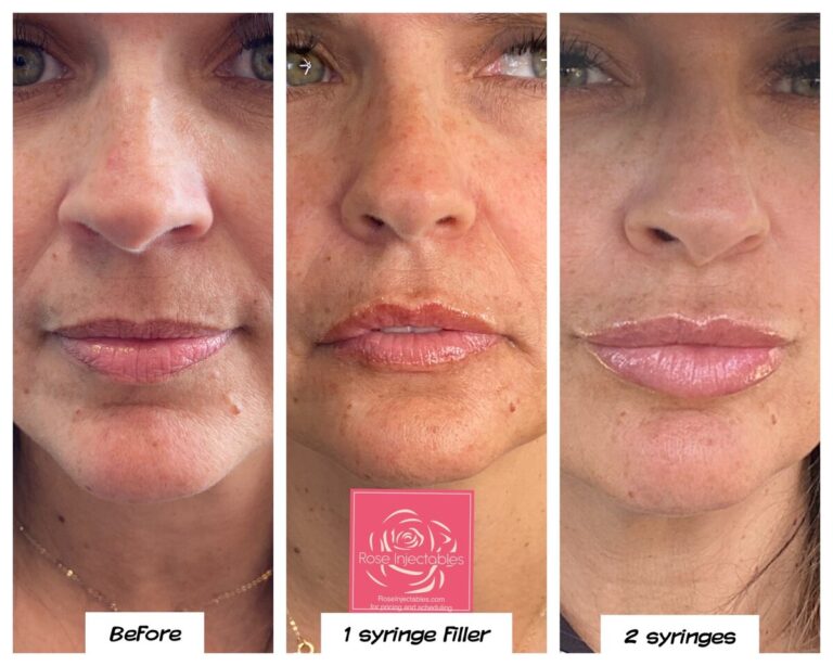 Dermal Fillers 6 | Rose Injectables