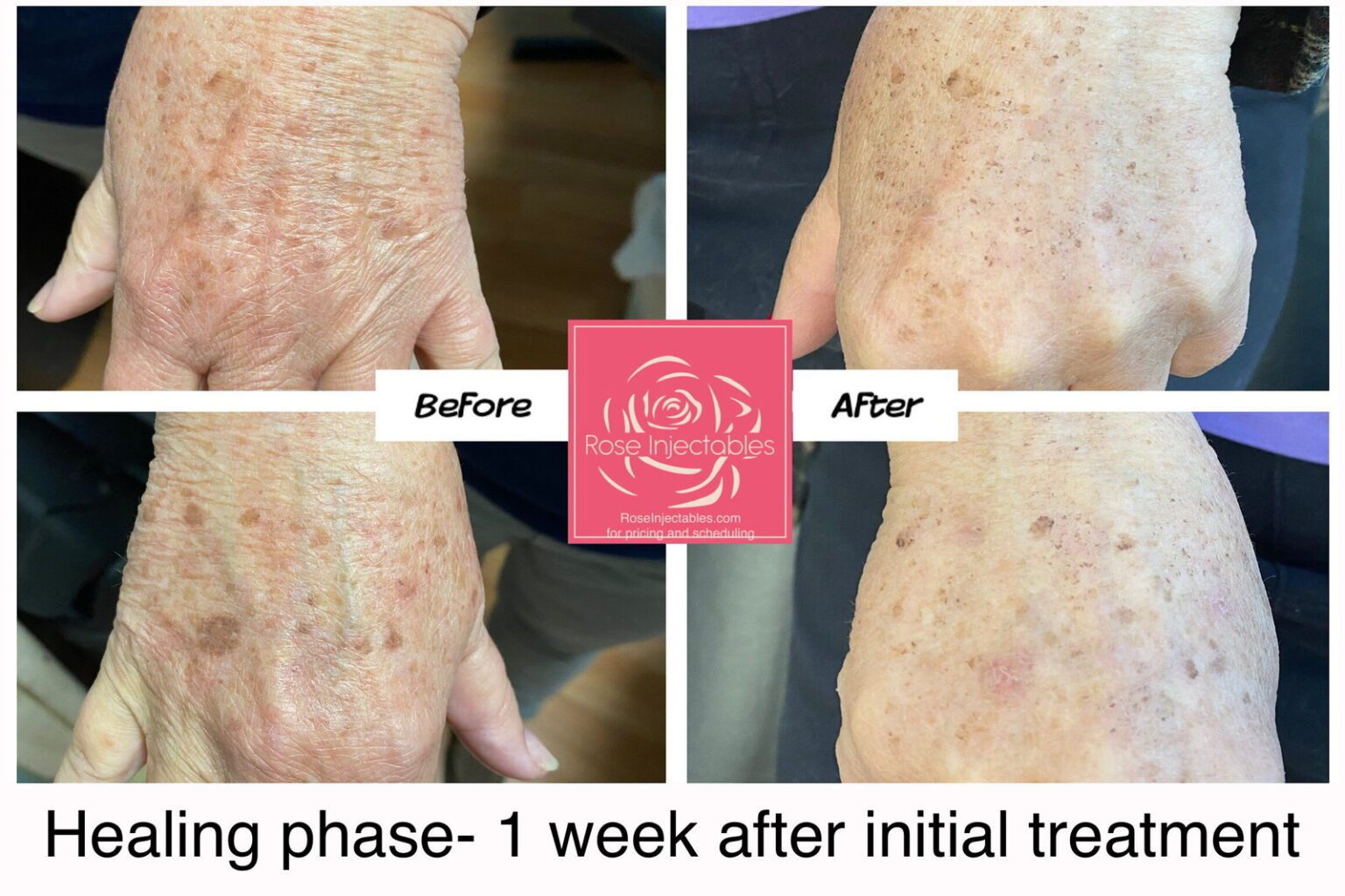 Lumecca IPL 5 | Rose Injectables