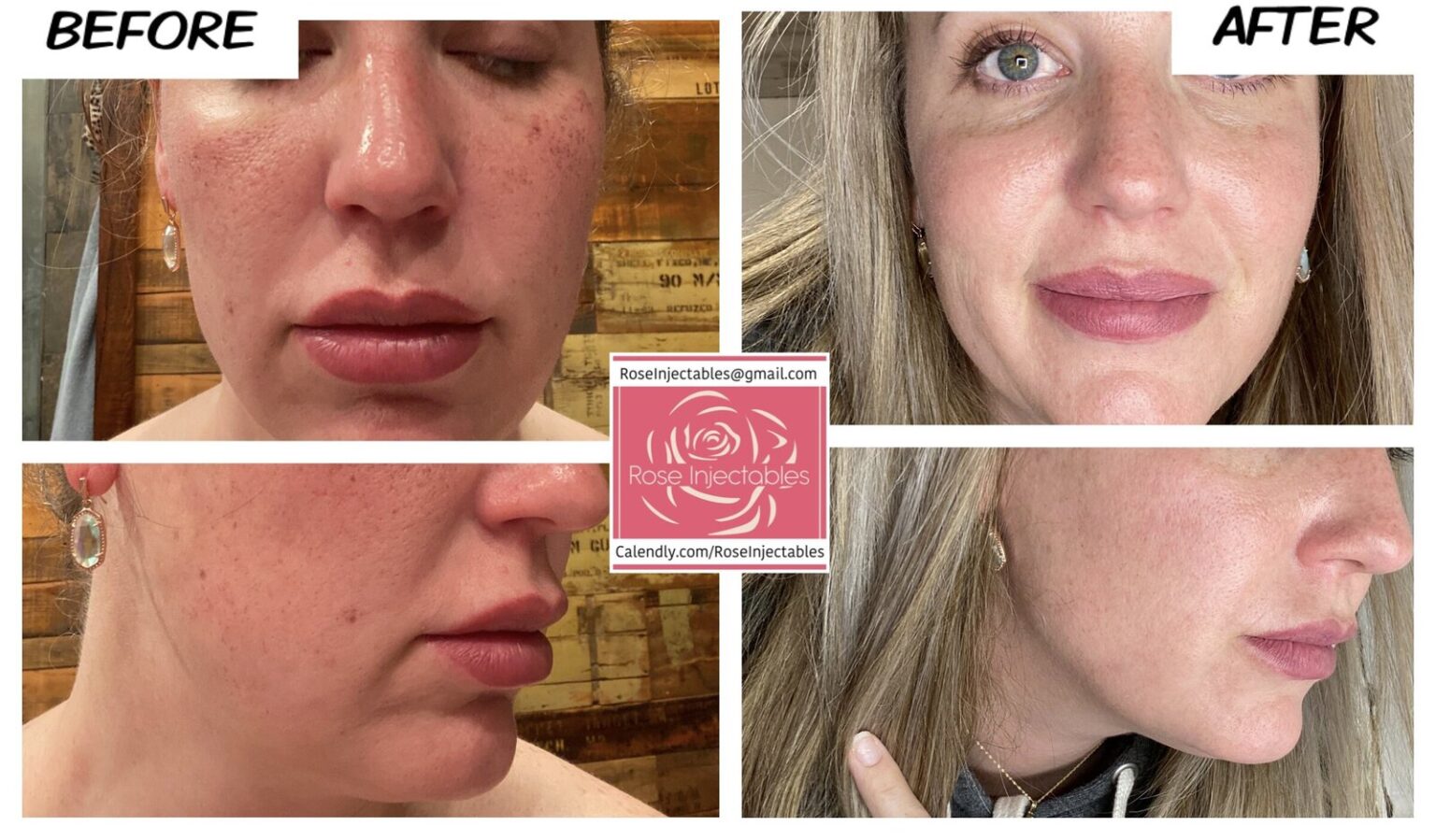 Lumecca IPL 2 | Rose Injectables